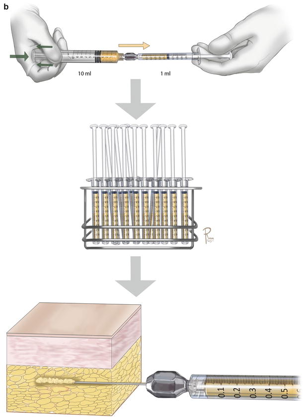 A How-to Guide on Structural Fat Grafting, Microfat Grafting, Sharp ...