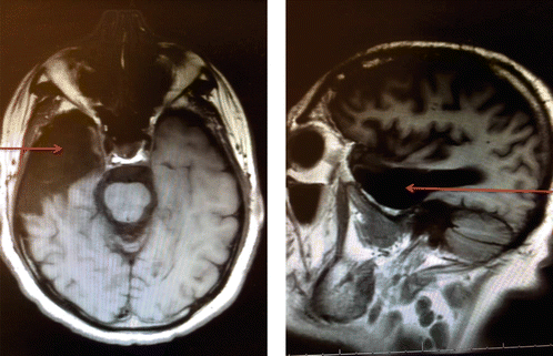 Temporal Lobe Syndromes | SpringerLink