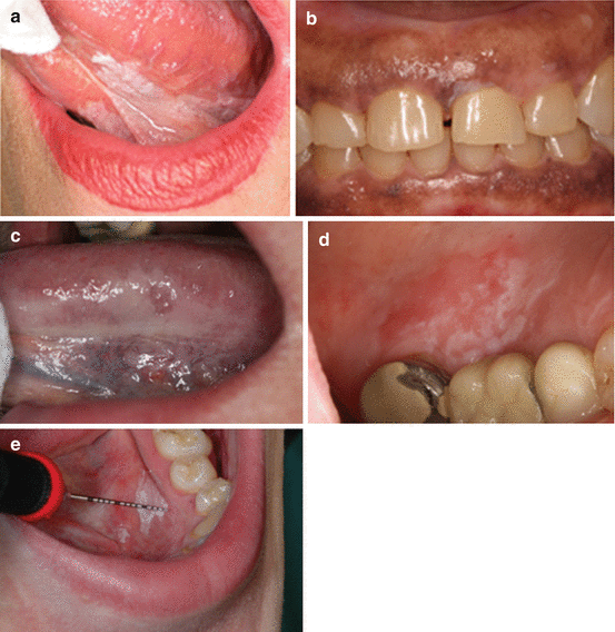 Common Lesions in Oral Pathology for the General Dentist | SpringerLink