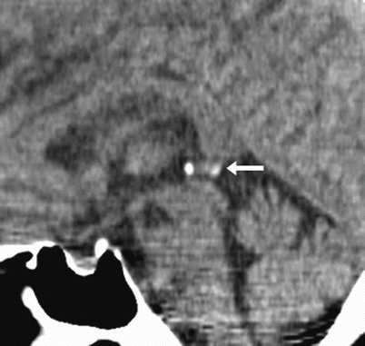 Pineal Gland: Normal Size, Appearance, and Enhancement | SpringerLink