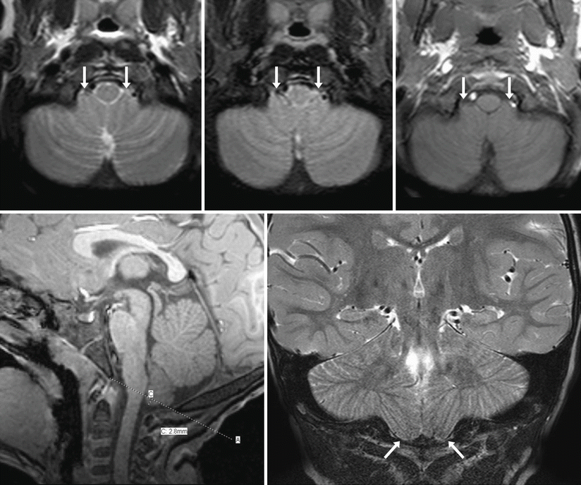 Cerebellar Tonsillar Ectopia | SpringerLink