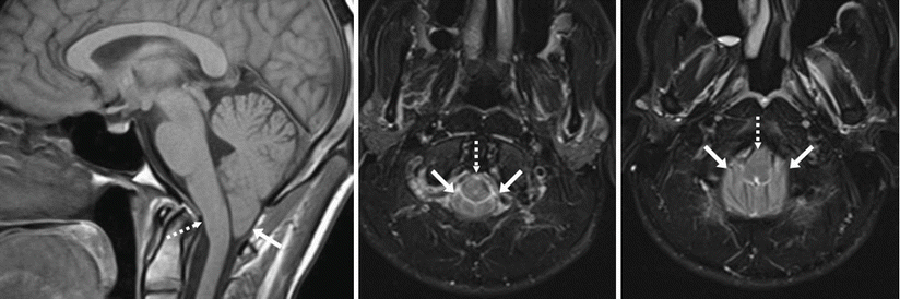 Cerebellar Tonsillar Ectopia | SpringerLink