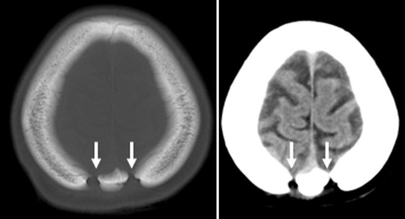 Emissary Veins, Vascular-Containing Foramina, and Vascular Depressions ...