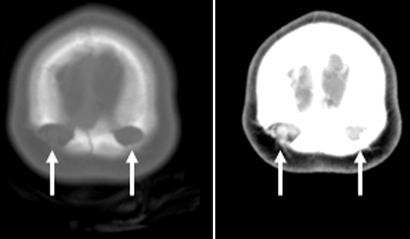 Emissary Veins, Vascular-Containing Foramina, and Vascular Depressions ...
