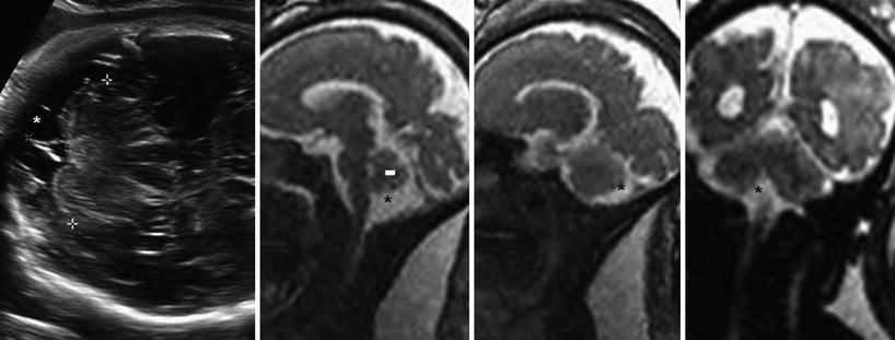 Mega Cisterna Magna and Retrocerebellar Arachnoid Cysts | SpringerLink
