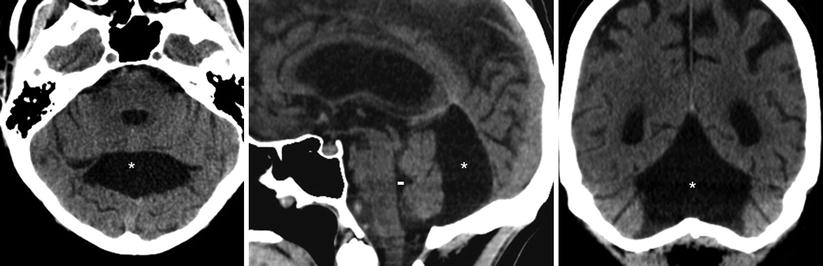 Mega Cisterna Magna and Retrocerebellar Arachnoid Cysts | SpringerLink