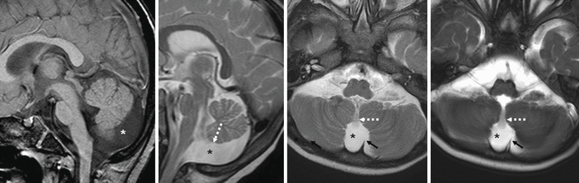 Mega Cisterna Magna and Retrocerebellar Arachnoid Cysts | SpringerLink