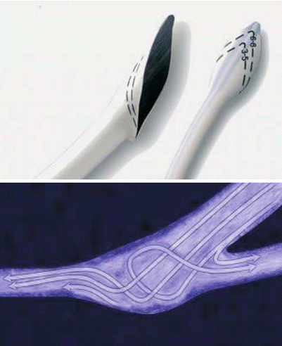 Hemodialysis Grafts | SpringerLink