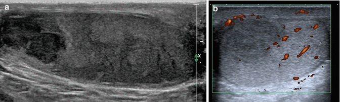 The Testicles: Trauma, Inflammation and Testicular Torsion | SpringerLink