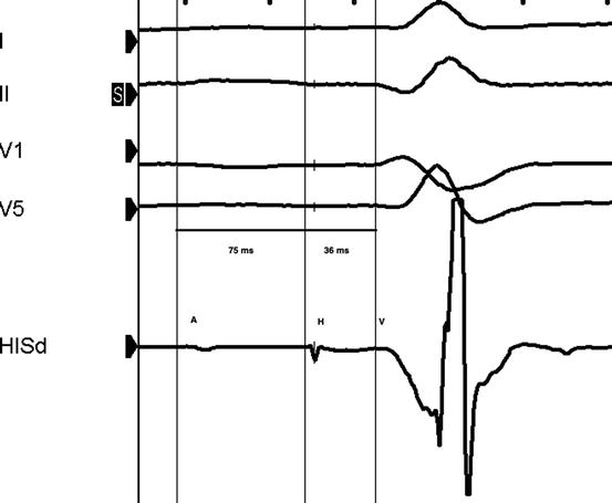 Cardiac Electrophysiology Study, Diagnostic Maneuvers and Ablation ...