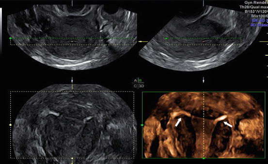 Ultrasound Examination of Tubal Patency: Hysterosalpingo-contrast ...