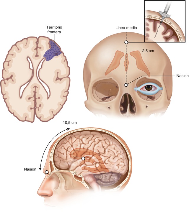 Advanced Monitoring in Neurocritical Care: Brain Tissue Oxygen Pressure ...