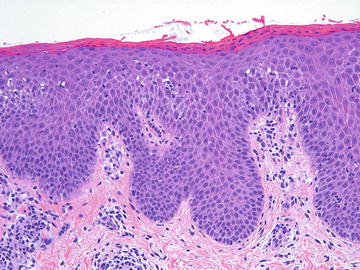 Spongiotic Dermatitis | SpringerLink