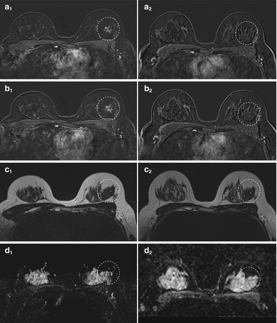 BI-RADS 3 Lesions on MRI | SpringerLink