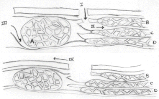 Anterior Component Separation Techniques | SpringerLink