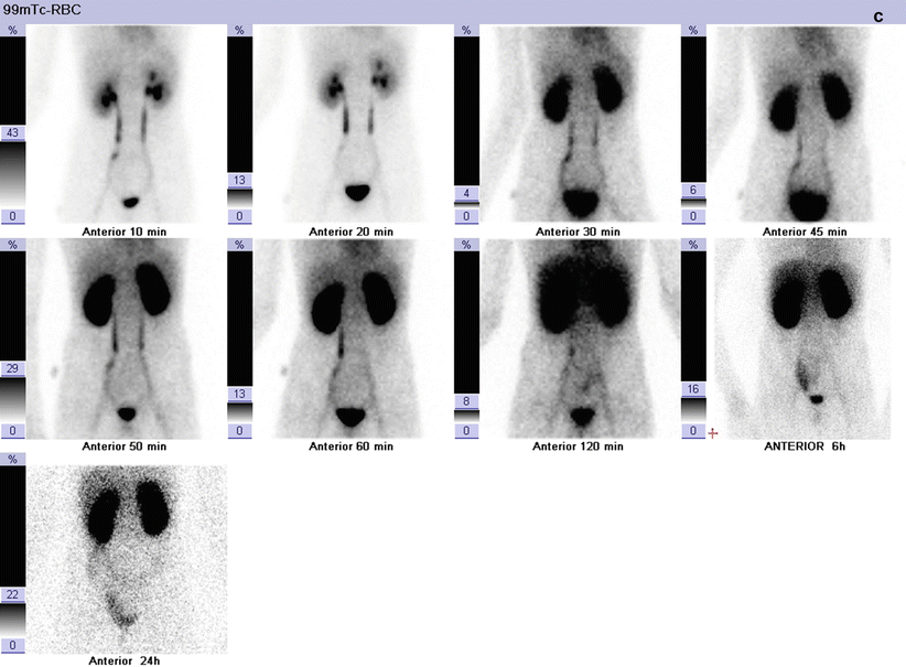 Gastroenterology: Intestinal Bleeding | SpringerLink