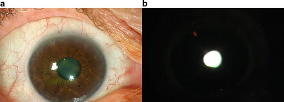 Laser Peripheral Iridoplasty | SpringerLink