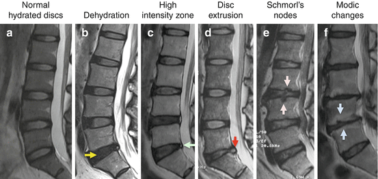 Intervertebral Disc Degeneration | SpringerLink
