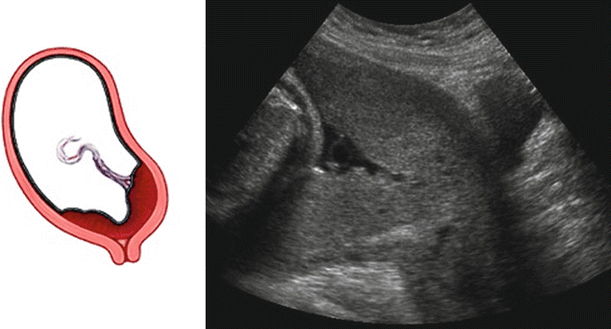 Placenta Previa | SpringerLink