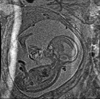 Neural Tube Defects | SpringerLink