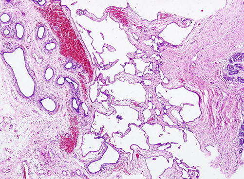 Congenital Cystic Pathology of the Rete Testis | SpringerLink