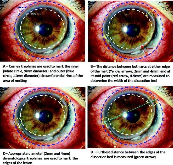 C-shaped Lamellar Corneal Patch Grafts “Match and Patch” Technique ...