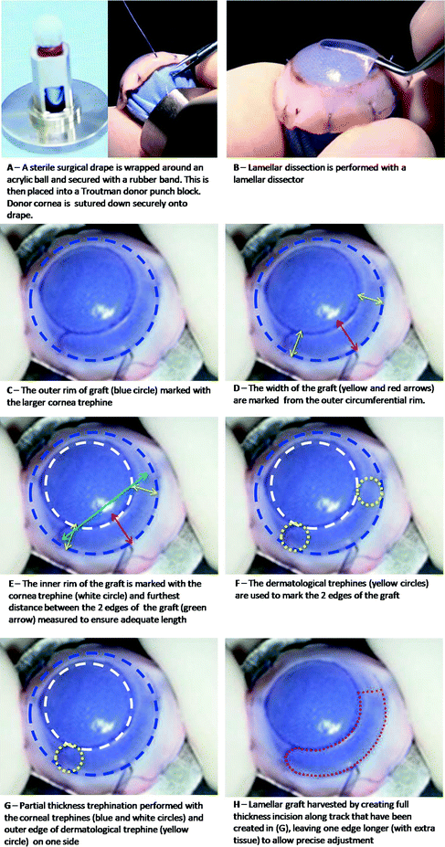 C-shaped Lamellar Corneal Patch Grafts “Match and Patch” Technique ...