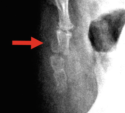 Coccyx Fracture and Dislocation | SpringerLink