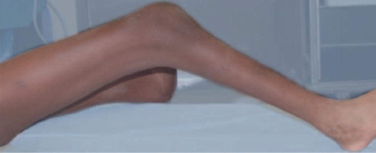 Knee Flexion Deformity in Cerebral Palsy | SpringerLink