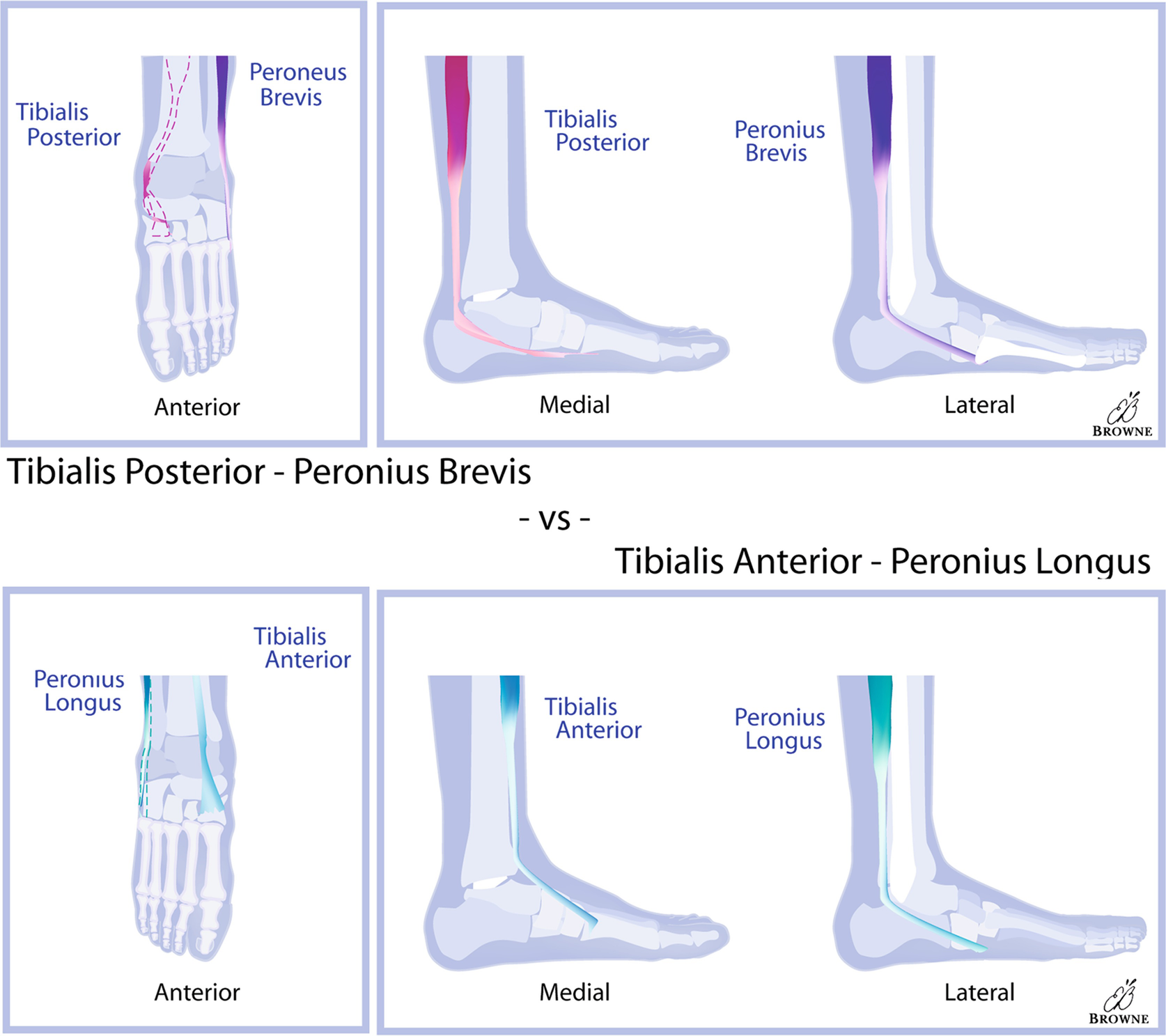 Planovalgus Foot Deformity in Cerebral Palsy | SpringerLink