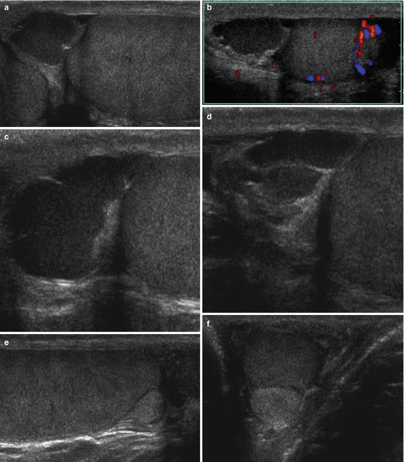 Extratesticular Lesions | SpringerLink