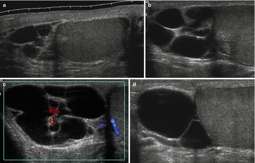 Extratesticular Lesions | SpringerLink