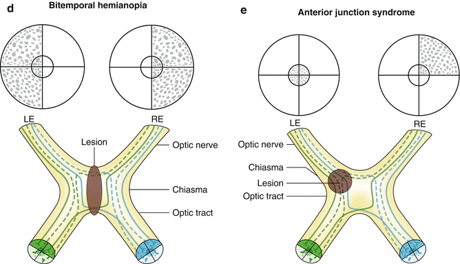 Types of Homonymous Visual Field Defects | SpringerLink