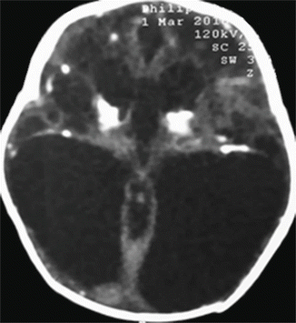 Radiological Differential Diagnosis of Microcephaly | SpringerLink