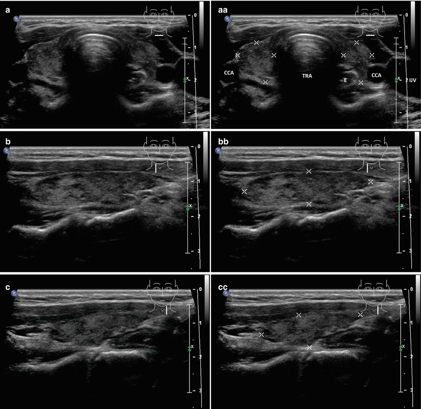 Hashimoto’s Thyroiditis | SpringerLink