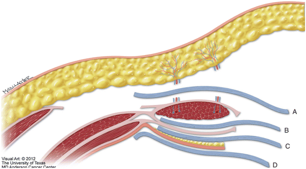 Complex Abdominal Wall Reconstruction-Plastic Surgeon’s Perspective ...