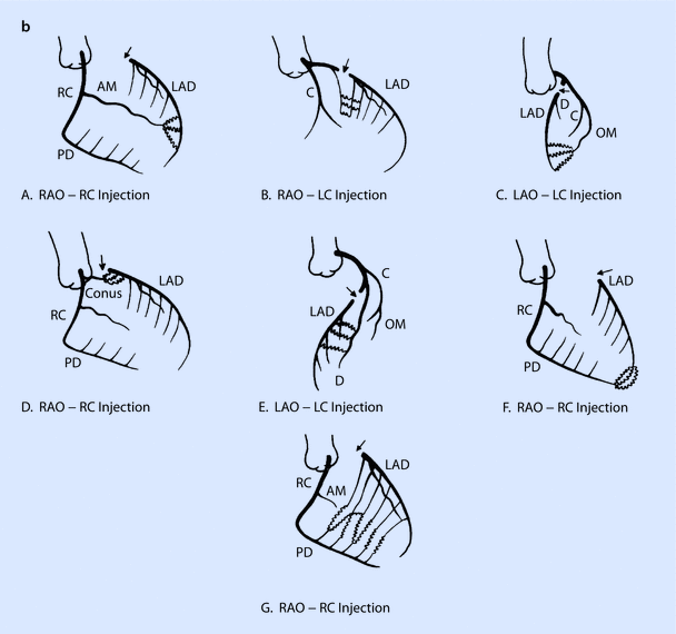 Coronary Collateral Circulation | SpringerLink