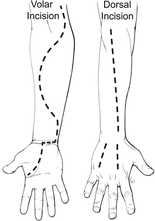 Soft Tissue Wounds and Fasciotomies | SpringerLink
