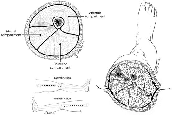 Soft Tissue Wounds and Fasciotomies | SpringerLink
