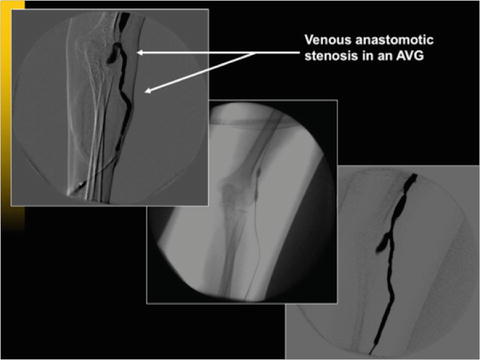Arteriovenous Graft Peri-anastomotic Outflow Stenosis | SpringerLink