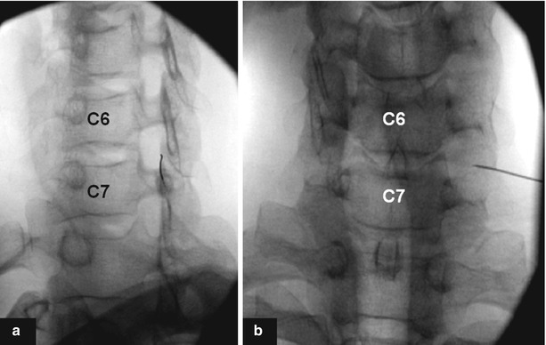 Death After Transforaminal Cervical Epidural Steroid Injection ...