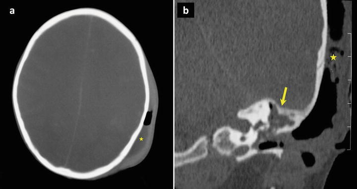 Scalp Abscesses | SpringerLink