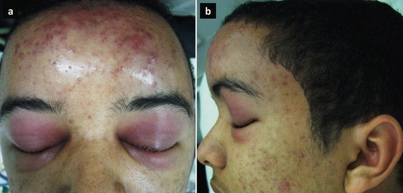 Scalp Abscesses | SpringerLink