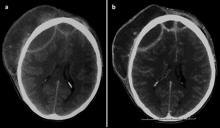 Scalp Abscesses | SpringerLink