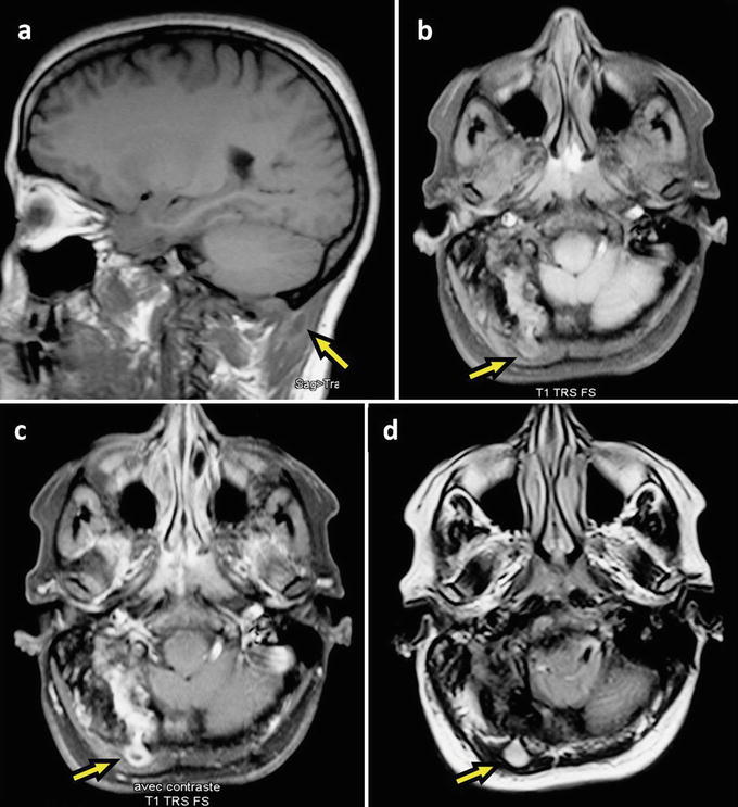 Cranial Osteomyelitis | SpringerLink