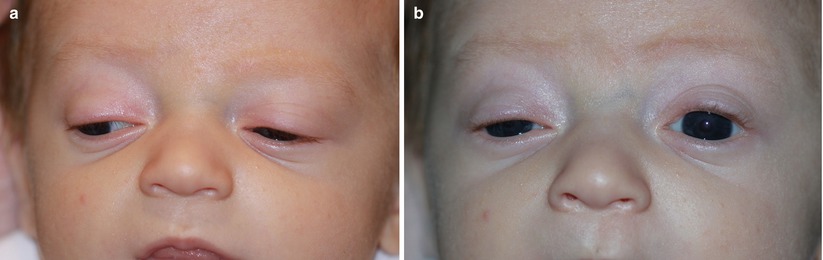 Pediatric Ptosis | SpringerLink