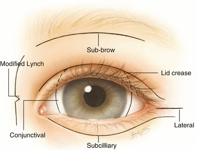 Surgical Approaches to the Pediatric Orbit | SpringerLink