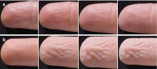 Diagnosis and Evaluation of Small Fiber Peripheral Neuropathy in ...