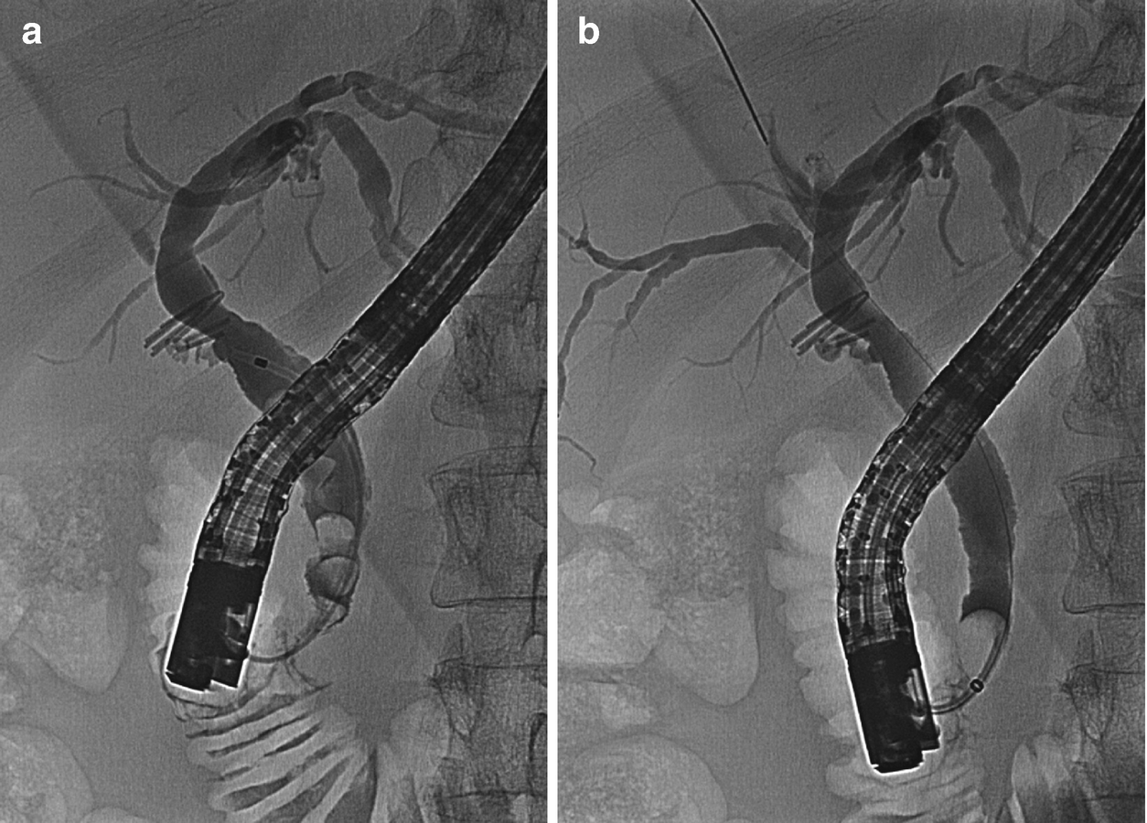 Transcystic Stenting and Post-Operative ERCP for CBD Stones at ...