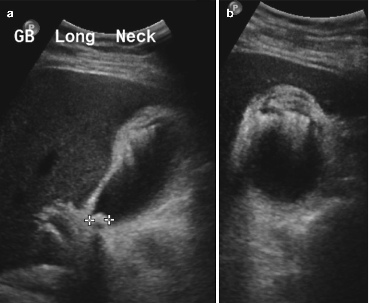 Gallbladder Polyps, Sludge and Adenomyomatosis | SpringerLink